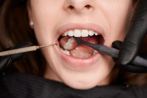 Understanding Dental Cavity Detection: How Dentists Diagnose Cavities